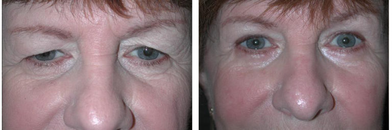 Eye Lift Gallery - Facial Cosmetic Surgery in Toronto from Dr. Richard ...