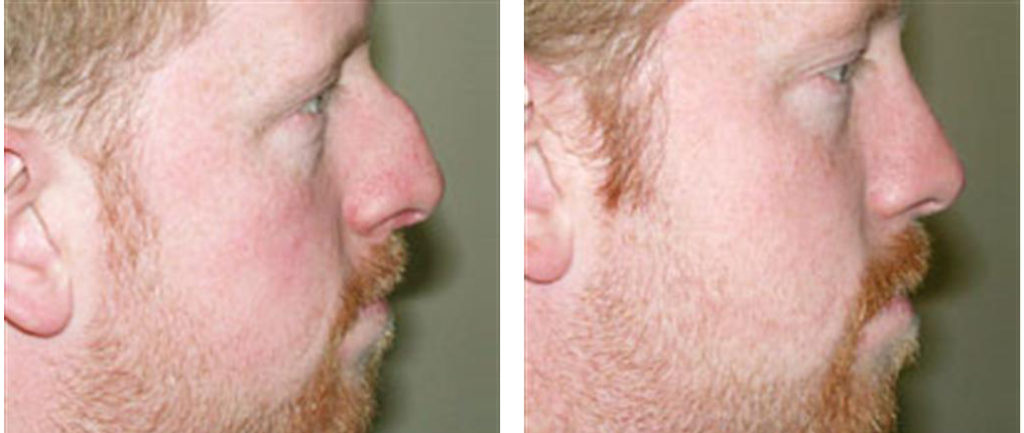 Rhinoplasty Gallery - Facial Cosmetic Surgery in Toronto from Dr ...