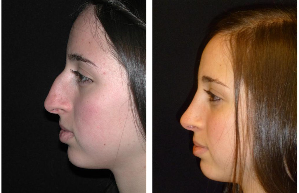 Rhinoplasty Gallery - Facial Cosmetic Surgery in Toronto from Dr ...