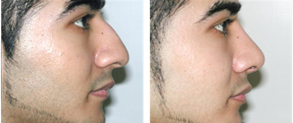 Rhinoplasty Gallery - Facial Cosmetic Surgery in Toronto from Dr ...