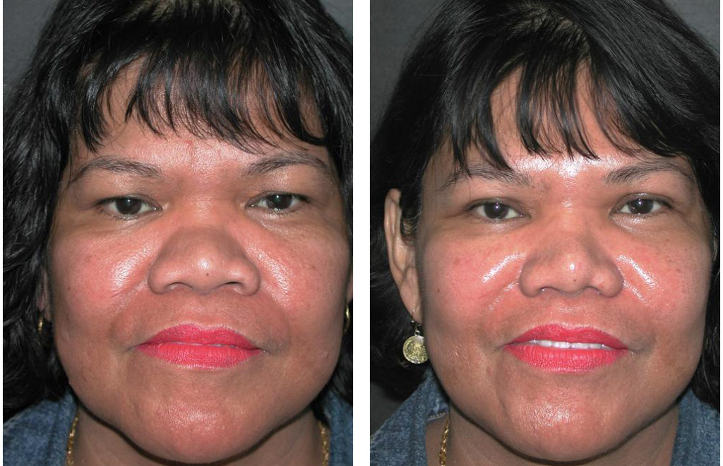 Rhinoplasty Gallery - Facial Cosmetic Surgery in Toronto from Dr ...