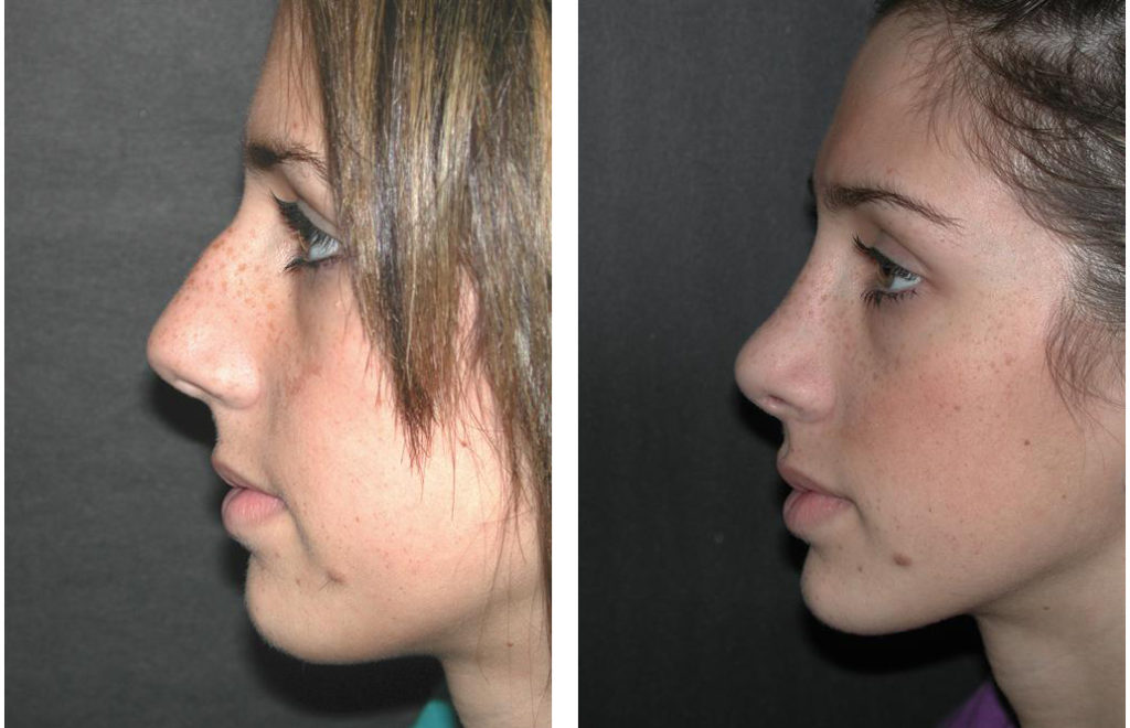 Rhinoplasty Gallery - Facial Cosmetic Surgery in Toronto from Dr ...